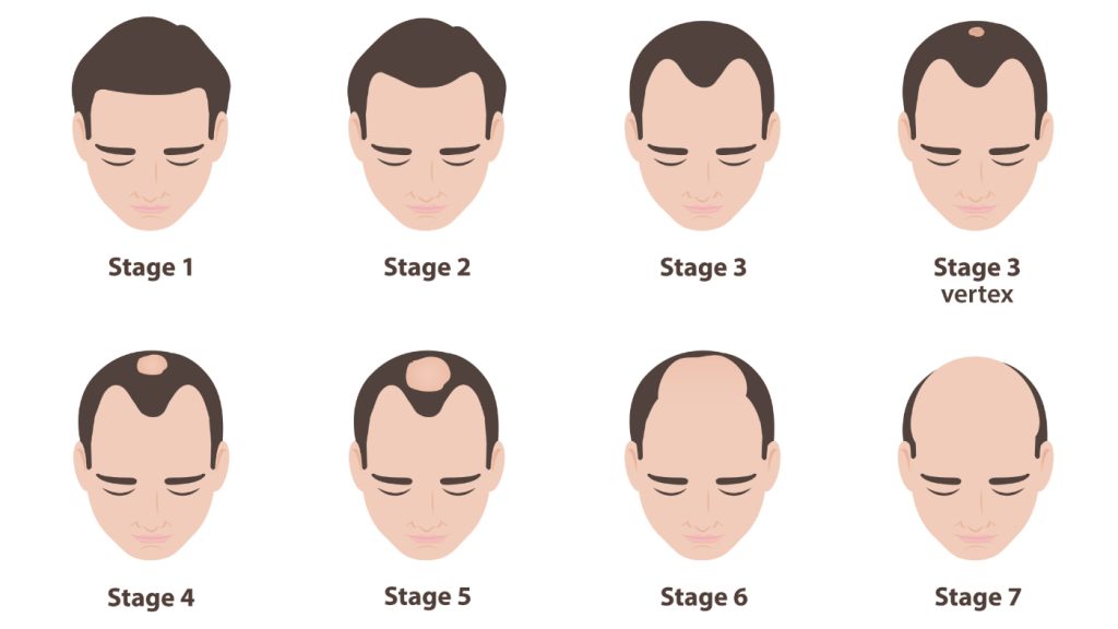 À quel âge faire une greffe de cheveux